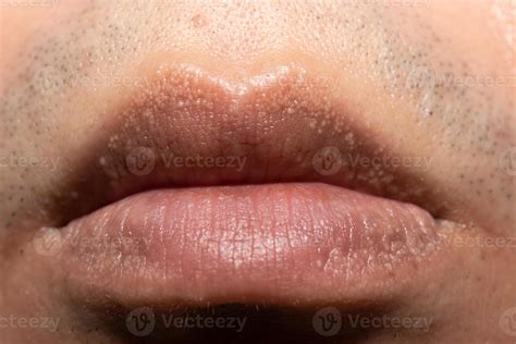 Fordyce Spots On Corner Of Lips Pictures And Videos