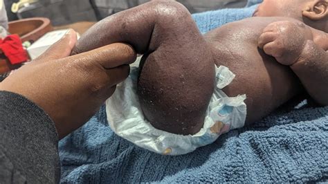 Ichthyosis Vs Eczema Richthyosis