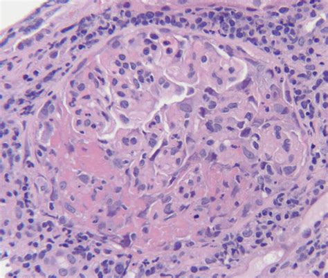 Pathology Classification And Pathogenesis Of Lupus Glomerulonephritis