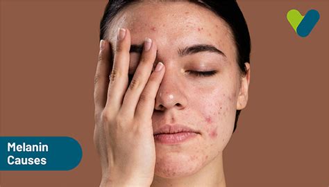 Melanin Deficiency Causes Understand The Melanin Increase Causes Livlong