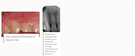 External Cervical Resorption In A Sound Tooth Endo Elements