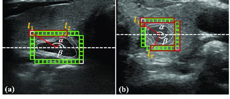 Relative Position Features Between The Nodule And The Thyroid Tissue