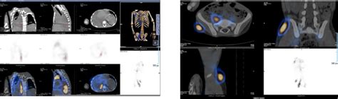 Figure 1 From Case Report Of Generalized Lymphatic Dysplasia With