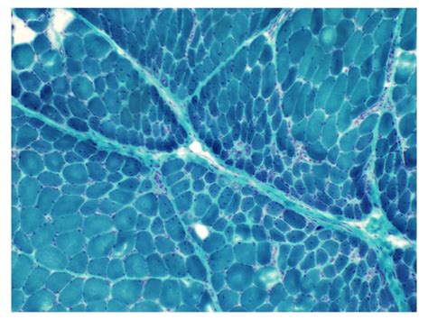 Pathology Outlines Dermatomyositis