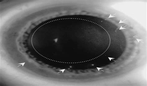 Photorefractive Keratectomy For Myopia In The Setting Of Thy Cornea