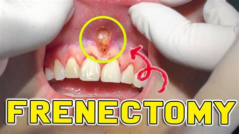 Frenectomy Using Laser At Bruce Macias Blog