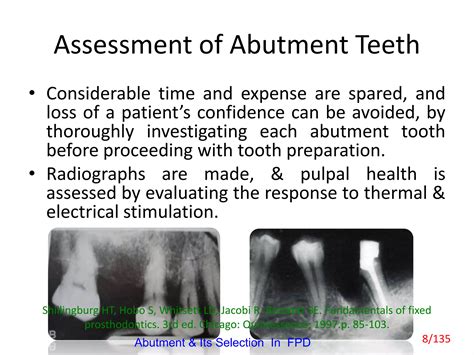 Abutment And Its Selection In Fixed Partial Denture Pptx