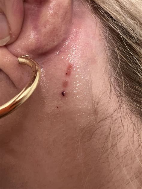 Scabies Behind My Ear Rscabies