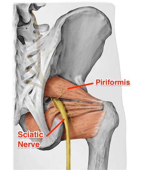 Unraveling The Complexities Of Piriformis Syndrome Academy Of Clinical