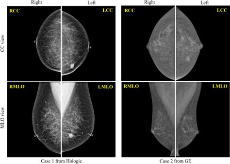 Leveraging Paired Mammogram Views With Deep Learning For Comprehensive
