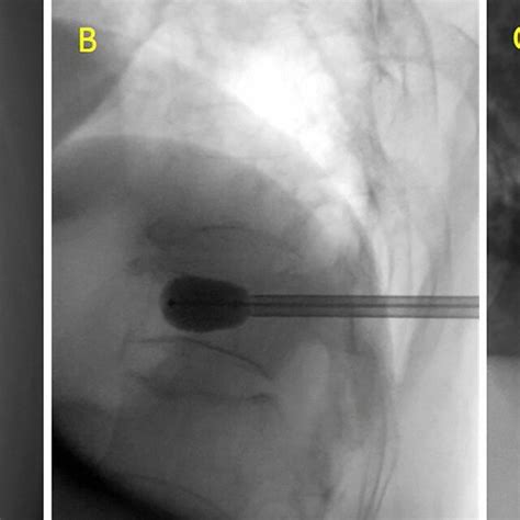 A Case Of T8 Vertebral Compression Fracture Treated With High Viscosity