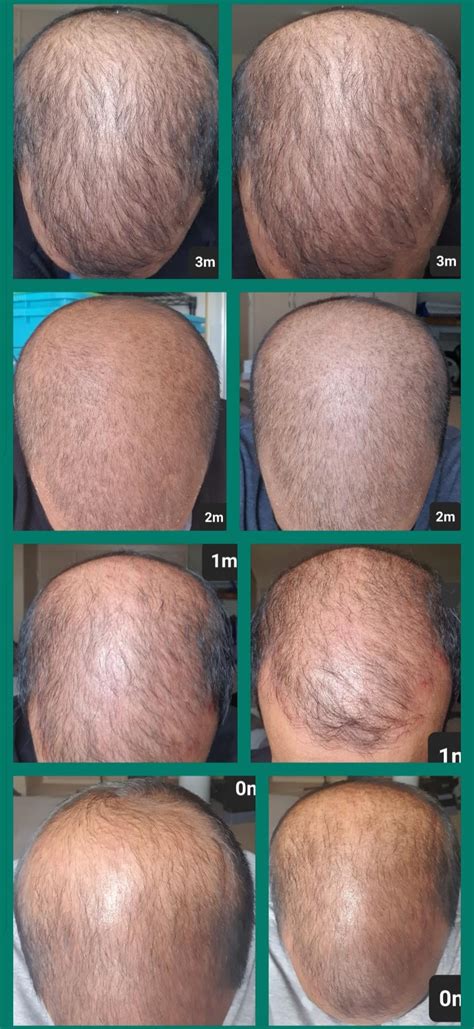 Microneedling Without Minoxidil Or Finasteride 3 Months In Rtressless