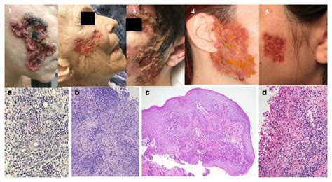 Lesions 1 5 And Histopathology A D Of Granulomatous Pyoderma Download Scientific Diagram