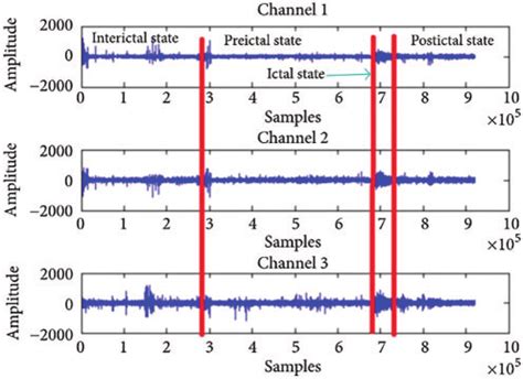 States Of Epileptic Seizure Adopted From 5 Download Scientific Diagram