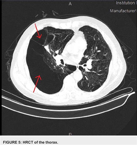Figure 5 From Giant Bullous Emphysema Mimicking Spontaneous
