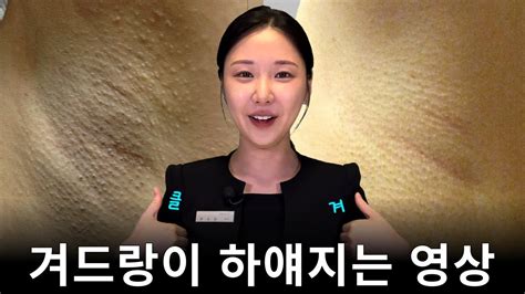 여름철 겨드랑이 관리법 겨드랑이색소침착 Youtube