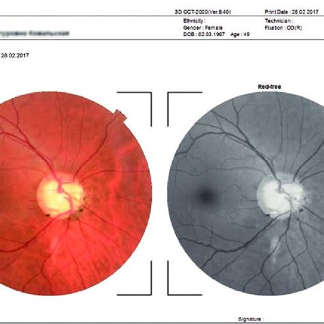 Ophthalmoscopic Picture Of Patient Ks Left Onh And Choroidal Coloboma