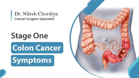 Stage One Colon Cancer Symptoms Dr Nilesh Chordiya