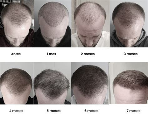 Top 155 7 Months After Hair Transplant Polarrunningexpeditions