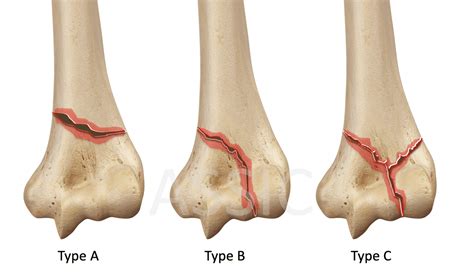 Elbow Distal Humerus Fracture Assic Education