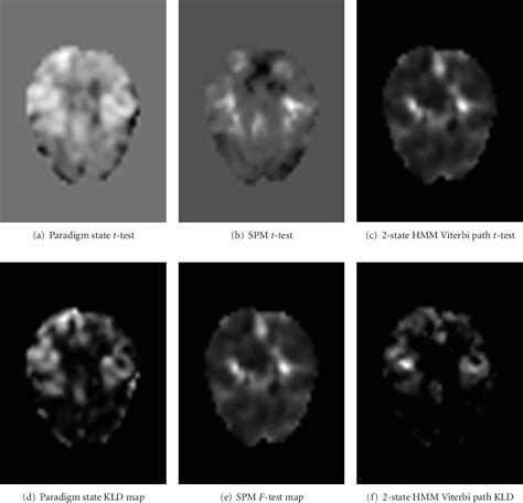 Figure 1 From Activation Detection On Fmri Time Series Using Hidden