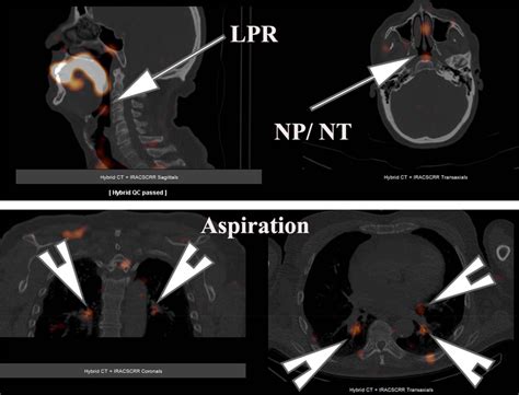 Image Of A Typical Patient With Pulmonary Aspiration The Upper Panel