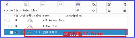 简单手术用心做 3d Slicer下基层硬膜外血肿篇 脑医汇