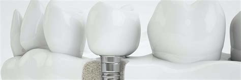 Root Canal Vs Implant Save Or Replace Your Tooth Root Canal Therapy
