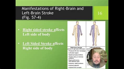 Chap 62 Stroke Youtube