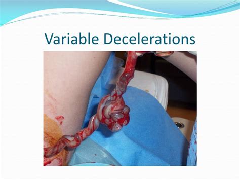 Ppt Fetal Monitoring Basics Expanded Powerpoint Presentation Free Download Id1901924