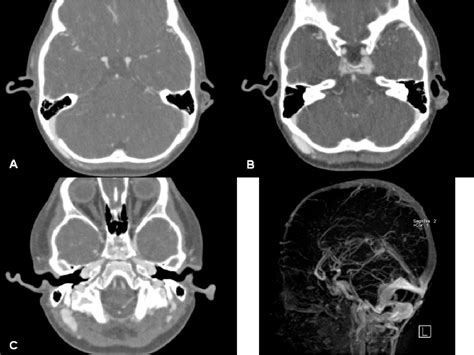 Figure 16 From Imaging Characterization Of Scalp And Skull Lesions Semantic Scholar
