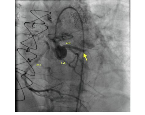 Coronary Angiogram Showing Occlusion Of Proximal LCX Coronary Artery Download Scientific