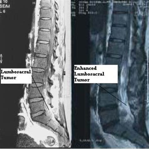 An Mri Of The Thoracic Spine Showed An Extradural Lesion Extending From