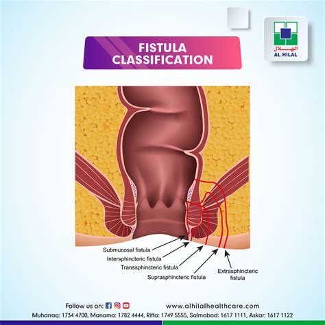 Fistula In Ano