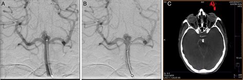 Demographic Procedural And 30 Day Safety Results From The Web Intra