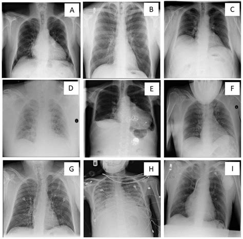Optimal And Suboptimal Chest X Rays A Optimal Quality Chest X Ray Download Scientific
