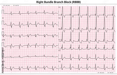 Ecg Rbbb Right Bundle Branch Block 12 Lead Ecg Common Case 6 Sec