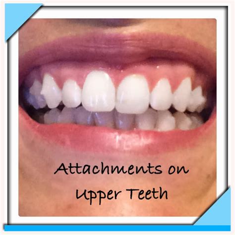 My Invisalign Journey April 2014