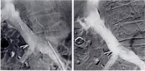 Repositioning Of Filter Angiogram After Injection Through Filter
