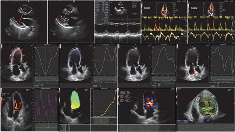 Conventional Echocardiography Speckle Tracking Echocardiography And Download Scientific