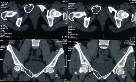 Pelvis Ct Scan Showing A Lytic Bone Lesion Of The Right Superior Pubic Download Scientific