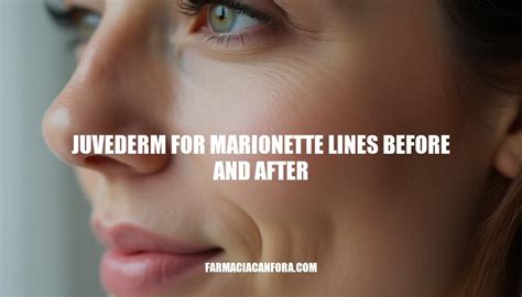 Juvederm For Marionette Lines Before And After Treatment Results