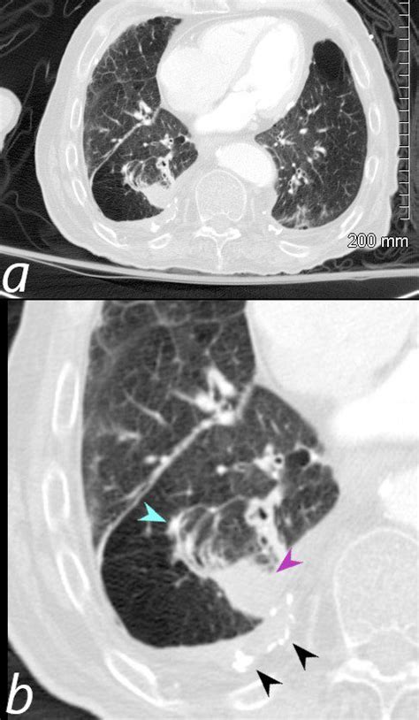 000 Atelectasis Rounded The Common Vein