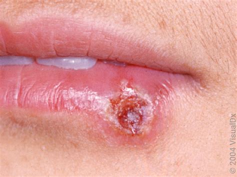 What Are Cold Sores Causes Symptoms And Treatments Goodrx