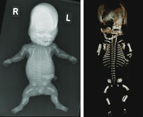 Pmss A And 3 Dimensional Reconstruction Of A Post Mortem Ct B This