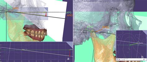 Calculate The Angle Deviations Of The Reference Plane A And The