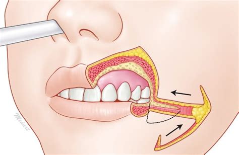 Diagram Of The Method Schematic Diagram Of Surgical Method Showing The Download Scientific