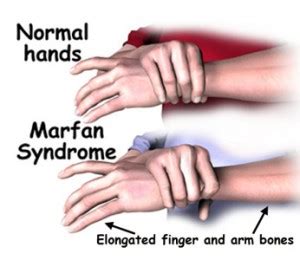 Marfan Syndrome Symptome Marfan Syndrom Ursachen Symptome Und