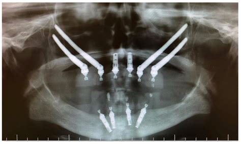 Immediate Loading Of Zygomatic Implants Using A Dual Scan Technique