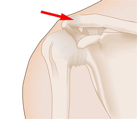 Acromioclavicular Joint Separation